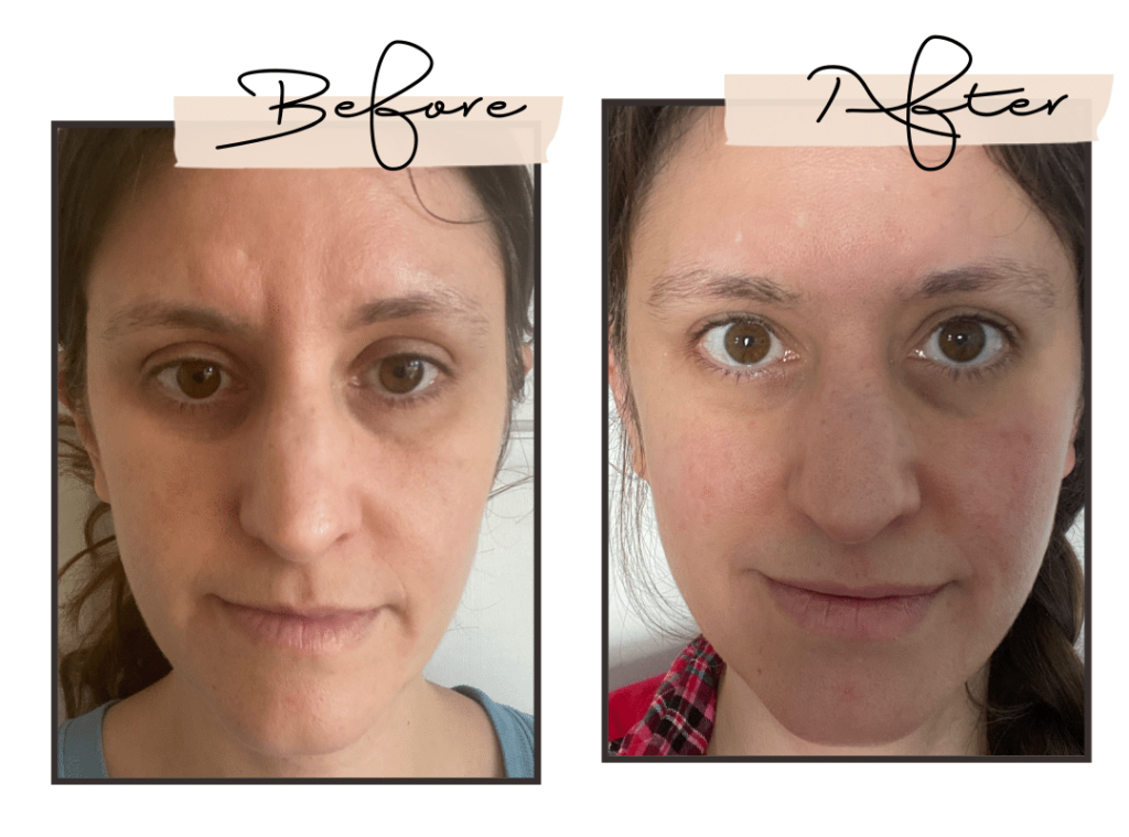 Rf Microneedling Before and After: At-Home Patch Results - The Vanilla Plum